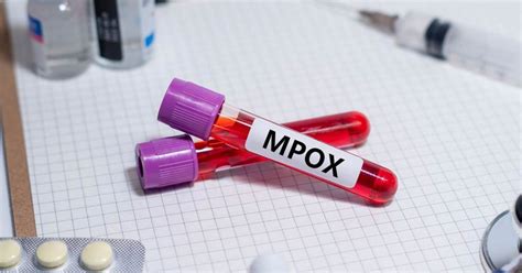 Mpox New Cases Emerge In South Africa MambaOnline LGBTQ South Africa Online