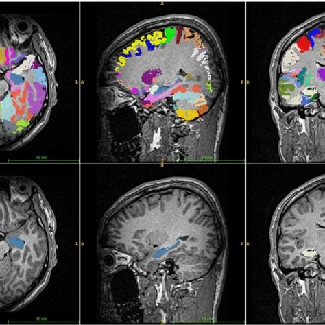 Images Showing Typical Automated Subcortical Segmentation Results From Download Scientific