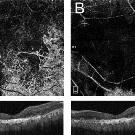 Enface Octa Structural Oct And Vessel Density Map Of Deep Capillary