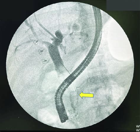 Cholangiographic Image Demonstrating A Linear Tubular Filling Defect Download Scientific