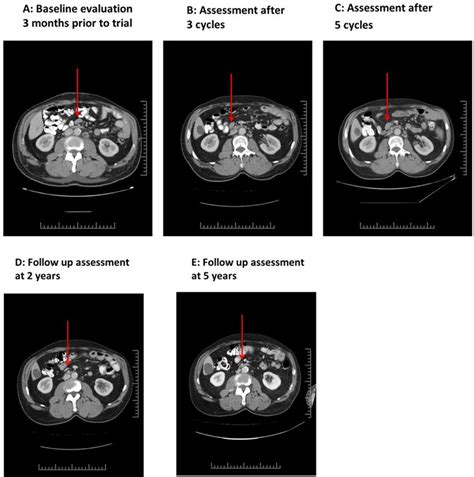 Patient 03 Serial Ct Scans Showing Appearance Of Mesenteric Lymph Nodes Download Scientific