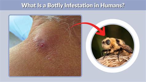 Botfly Infestation In Humans Causes Symptoms And Treatment