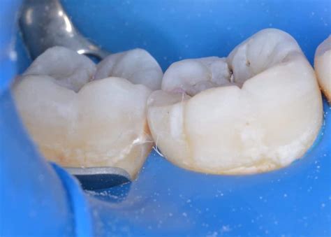 A Recipe For Class Ii Composite Restoration Myzerodonto