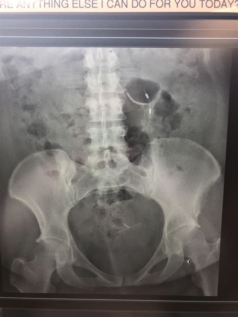 Intra Abdominal Finding Of A Copper Iud R Medicine