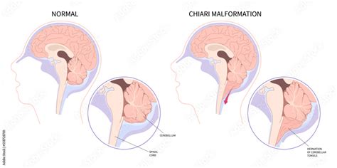 Anatomy Of Brain Cancer Tumor Bleeding With Chiari Malformation Stock