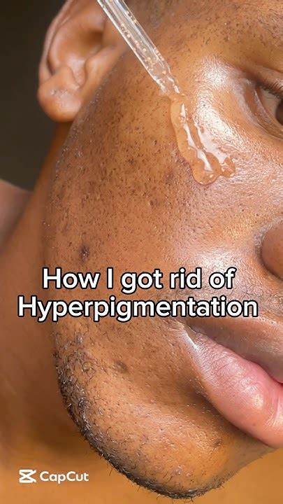 How I Got Rid Of My Hyperpigmentation Hyperpigmentation Enlargedpores Aestheticdermatology