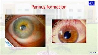 Corneal Signs Ppt Pptx