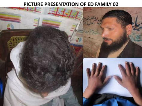 Ectodermal Dysplasias Genetic Disorder Pptx Skin And Dermatology Diseases And Conditions