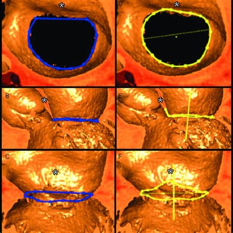 Mitral Valve Leaflets Download Scientific Diagram