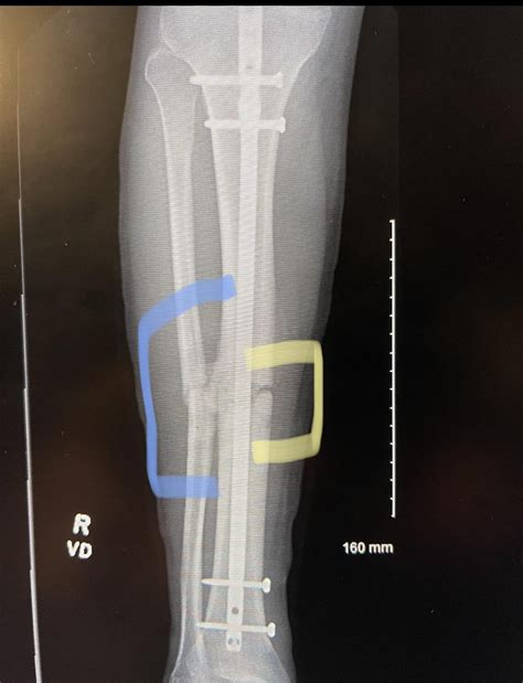 Hi All Broke 13 Bones Back In May Currently Dealing With My Right Tib Fib I Dont Have Any