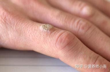 精准清除寻常疣和扁平疣你需要一支去疣神笔 知乎