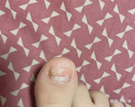 灰指甲治疗路程 知乎