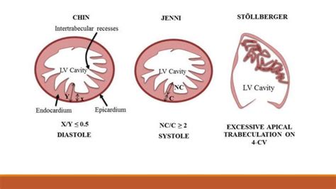 Left Ventricular Noncompaction Ppt