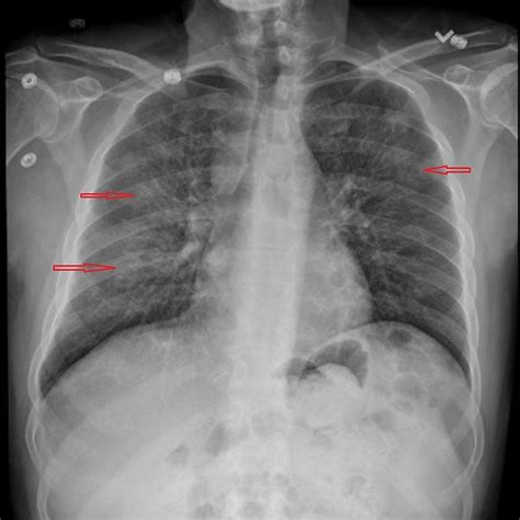 Chest X Ray Demonstrating Mild Diffuse Hazy Opacities Red Arrows