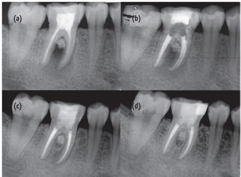 A Pretreatment Radiography Of Tooth 46 Note The Radiolucency In The