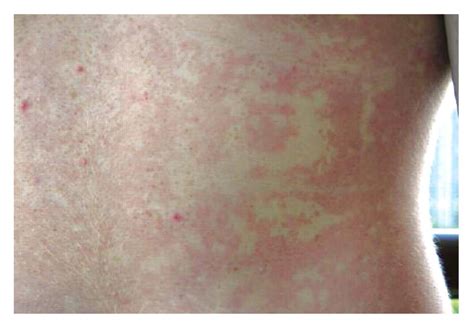 The Serpiginous Nonpruritic Rash Of Erythema Marginatum Which
