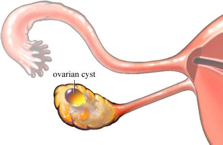Ovarian Cyst International Womens Clinic