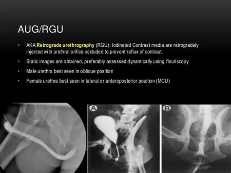 Ascending Urethrogram