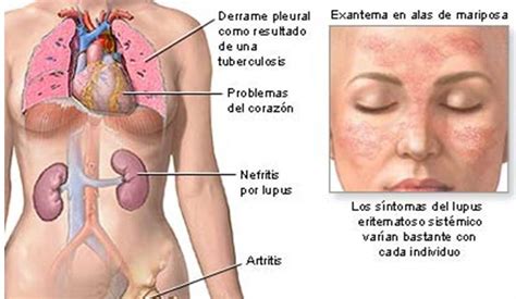5 อาการบ่งบอกสัญญาณโรคพุ่มพวง หรือ Sle โรคพุ่มพวง หรือโรคแพ้ภูมิตัวเอง Sle มีอาการอย่างไร