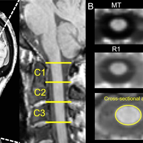 Illustration Of Measures Of Spinal Cord Multi Parametric Mapping Mpm Download Scientific