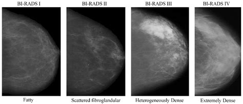 Twoviewdensitynet Two View Mammographic Breast Density Classification Based On Deep