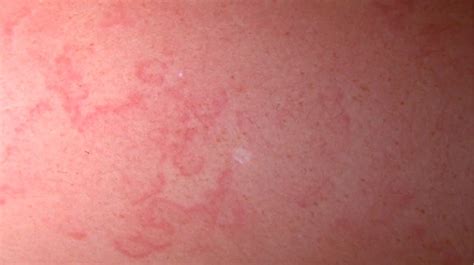 Chest Rash