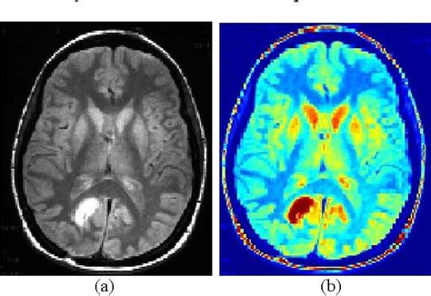 Aspect View Of Image Segmentation A Mri Image B Segmented Image Download Scientific Diagram