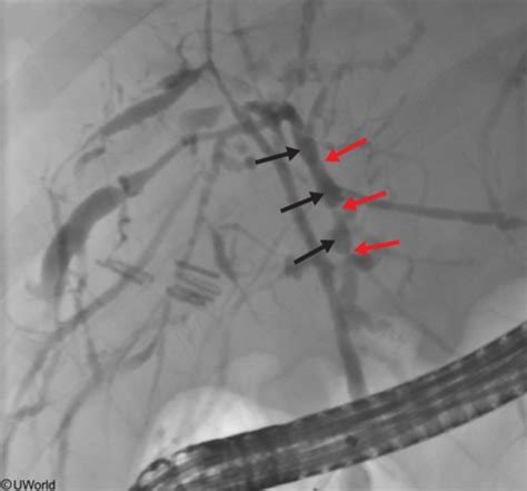 Primary Sclerosing Cholangitis PSC Flashcards Quizlet