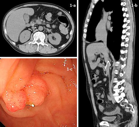 Ivc Filter Perforation Through The Duodenum Pmc