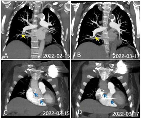 Ct Scan Of The Pulmonary Artery A Cta On Admission Showed Pulmonary Download Scientific