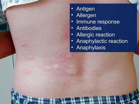 Chapter 21 Anaphylactic Reactions For Emt Pptx