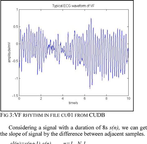 Figure 1 From A Shockable Rhythm Detection Algorithm Using Slope
