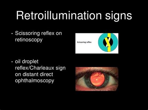 Keratoconus