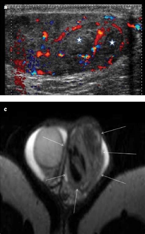 Figure 2 From Segmental Testicular Infarction Role Of Imaging Semantic Scholar