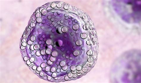 First Hit On Autologous Stem Cell Transplantation In Mantle Cell Lymphoma Oncodaily