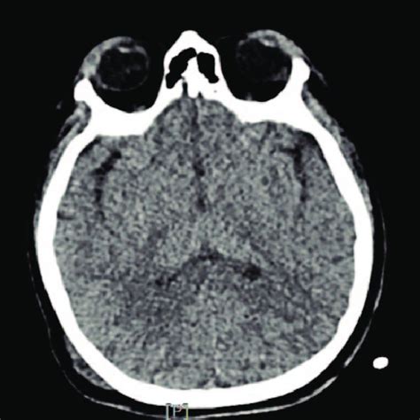 Ct Of The Brain There Are Hematoma And Emphysema Along The Right Download Scientific Diagram