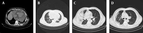 A Cardiomegaly With Pleural And Pericardial Effusion And Sub Segmental Download Scientific