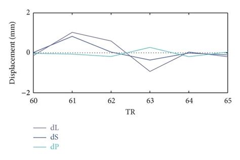 Improved Motion Correction By Adding Despiking Step The 6 Motion