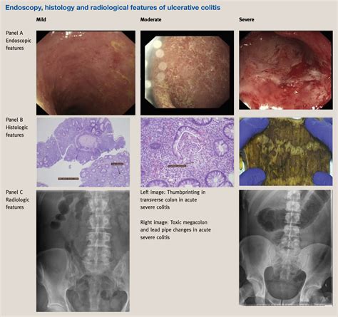 Ulcerative Colitis Endoscopy Ulcerative Colitis Knowledge Amboss