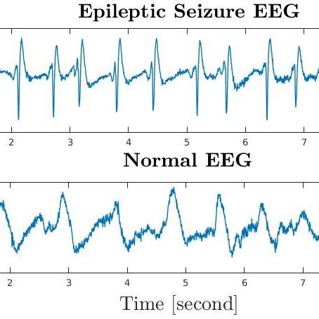 Epileptic Seizure EEG Vs Normal EEG Download Scientific Diagram