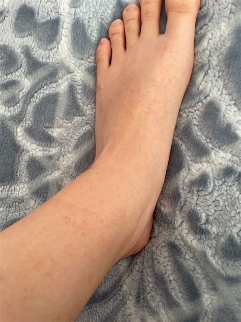 발에 빨간점이 많아요 지식in