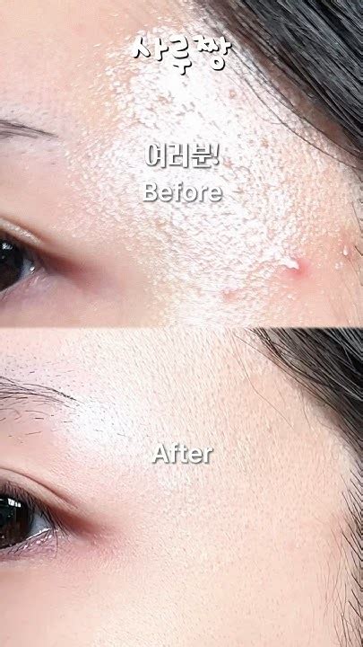 올리브영 추천템 좁쌀여드름 제거 꿀팁 3가지💡 여드름패치 유수분밸런스 프로폴리스 Youtube