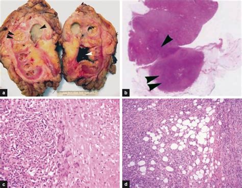 A Gross Nephrectomy Specimen Showing Characteristic Lobulated Download Scientific Diagram