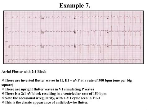 Atrial Fib Flutter PPTX Heart And Cardiovascular Diseases