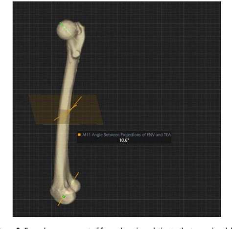 Figure 1 From Femoral Neck Anteversion Which Distal Femur Landmark Matters Semantic Scholar
