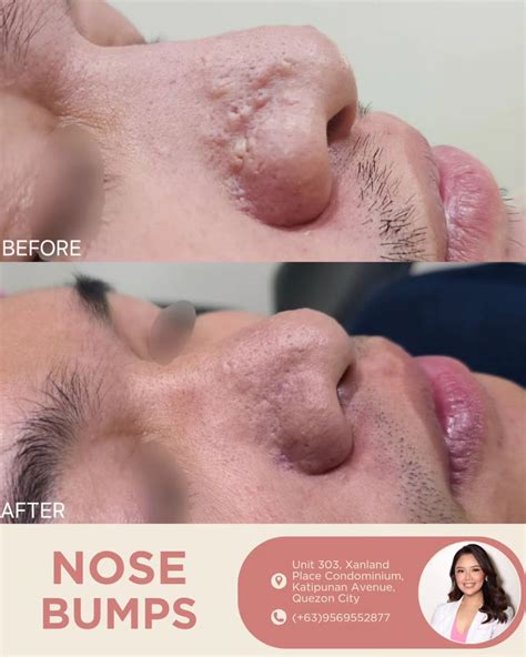 Doctora Pimple Popper Doc Athena Quezon City