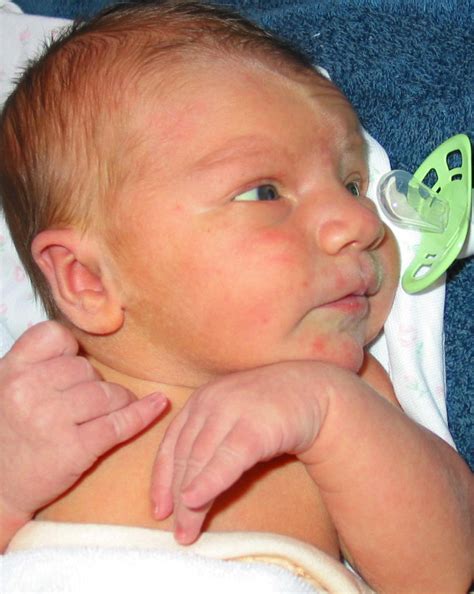 Erythema Toxicum Neonatorum Toxic Erythema Of The Newborn Toxic Erythema Dermatology Advisor