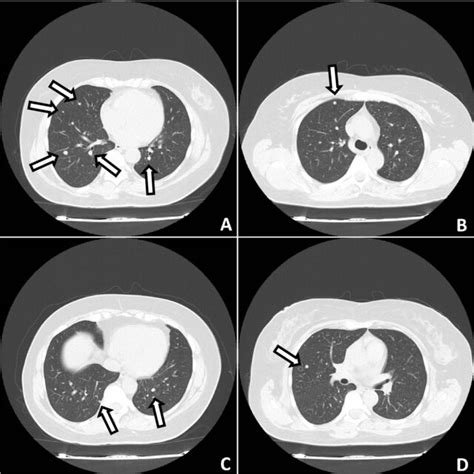 Ct Of The Lungs Lung Nodules Are Visible In Both Lungs Arrows A D Download Scientific