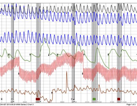 Understanding The Polygraph Chart A Deep Dive Into Lie Detection Lie Detector Test