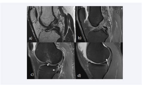 Knee Anatomy Sulcus Terminalis